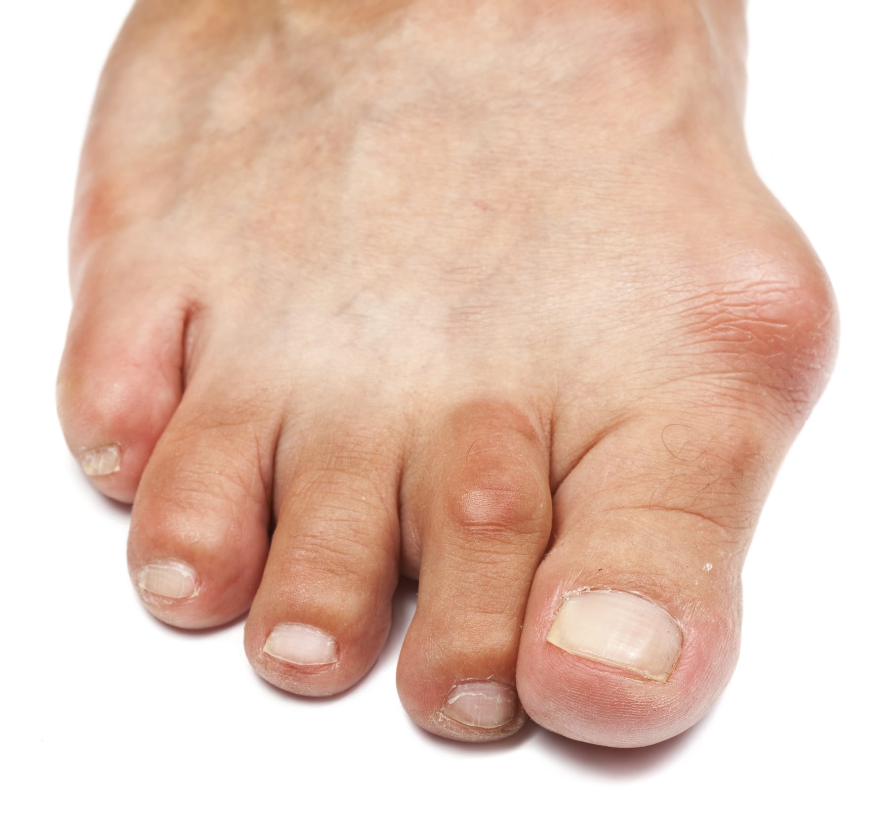 Gout - Symptoms, Treatment & Causes | MyHealthcare Clinic
